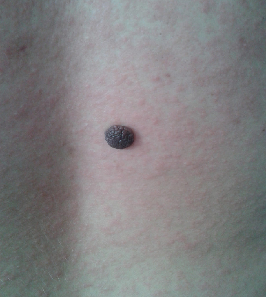 Benign moles - dr. Anton dermatologist