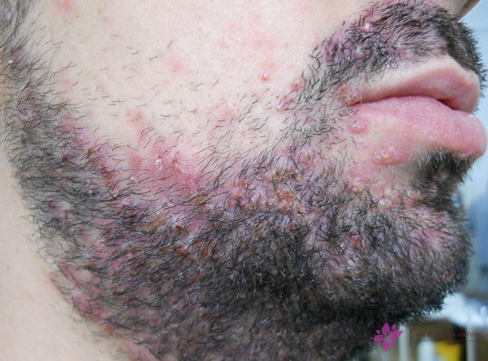 Folliculitis - dr. Anton dermatologist