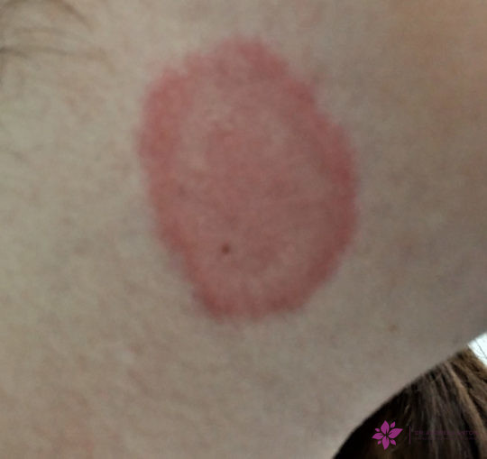 Ringworm (Tinea) - dr. Anton dermatologist