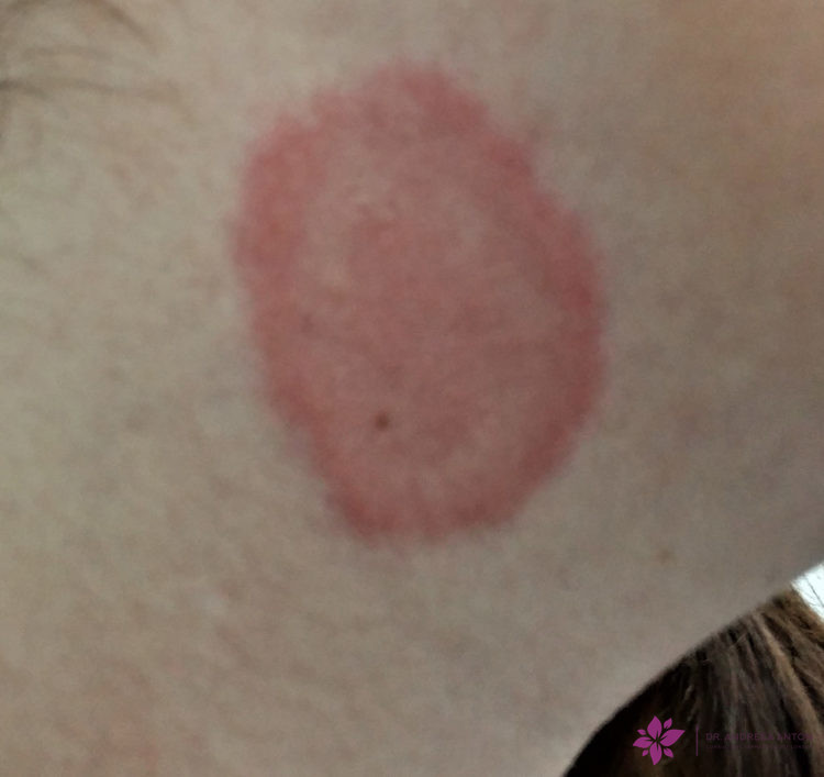 Ringworm (Tinea) - dr. Anton dermatologist